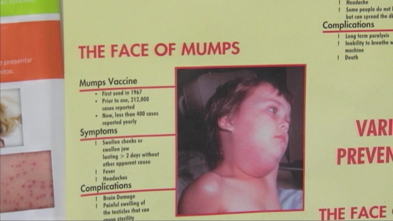 A closer look at mumps outbreaks in the United States